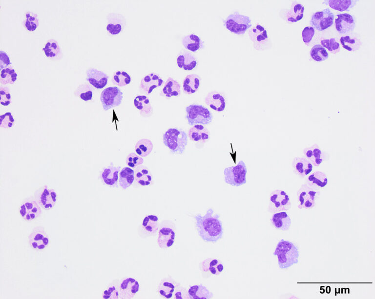 Figure 1: Cytospin smear of cerebrospinal fluid collected from the ...