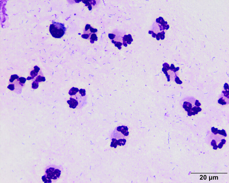 Figure 1: Aspirate of a cystic hepatic mass in a dog | eClinpath