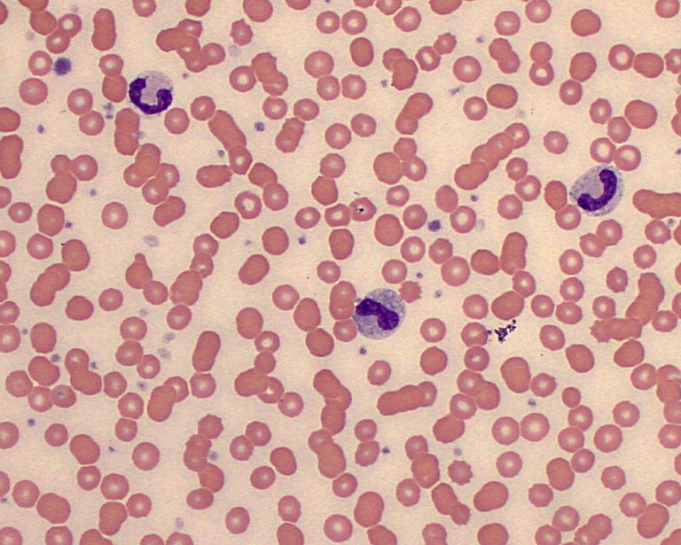 Inflammatory leukogram in a dog with metritis | eClinpath